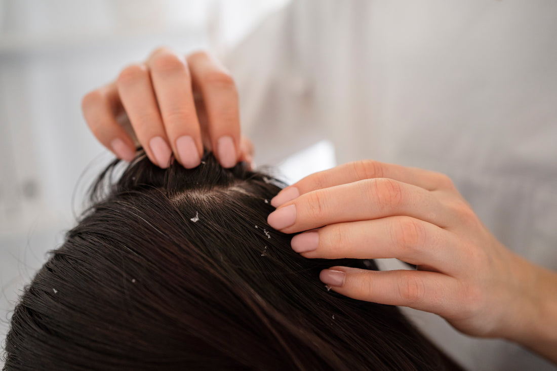 How to Remove Dandruff | Causes, Treatment & Care Tips – Justhuman